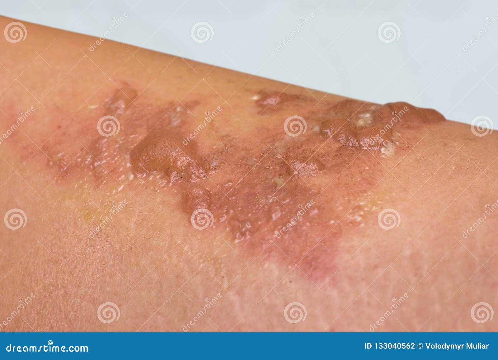 Skin Burn on the Leg of a Young Woman_ Stock Photo - Image of doctor ...