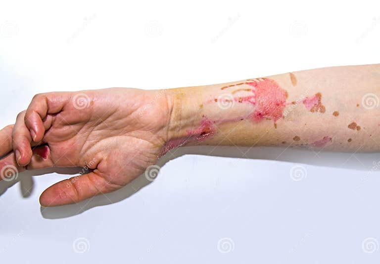 Skin burns on human arm stock photo. Image of sore, burns - 85499054