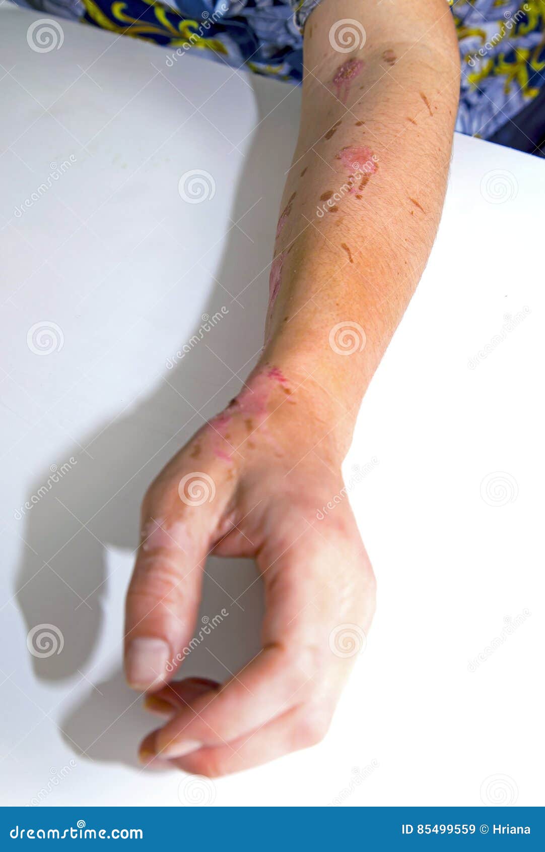 Skin burns on human arm stock image. Image of woman, sore - 85499559
