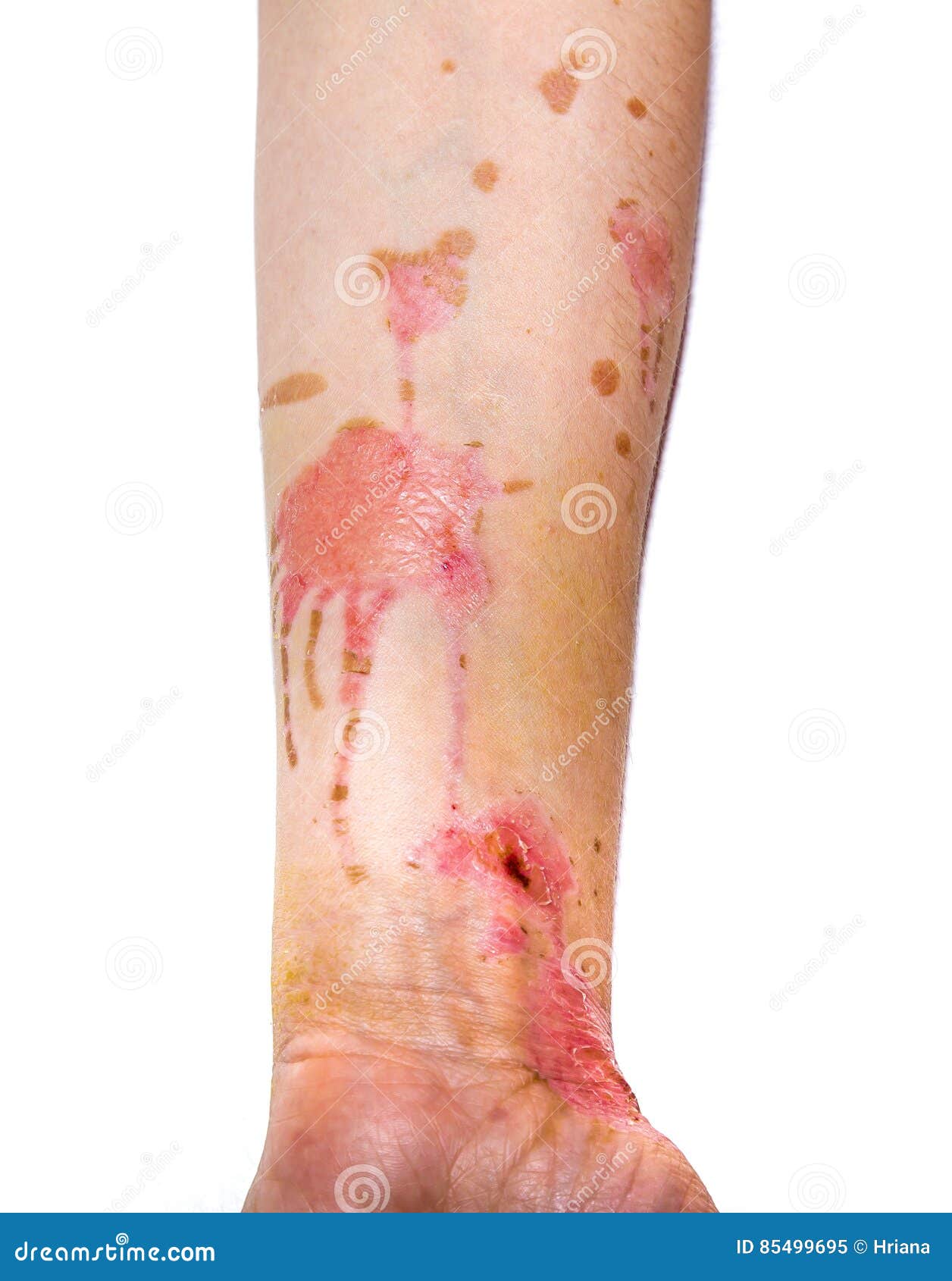 Skin burns on human arm stock image. Image of tissue - 85499695