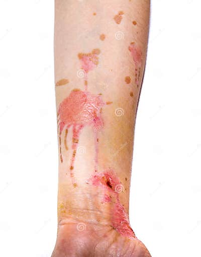 Skin burns on human arm stock image. Image of tissue - 85499695