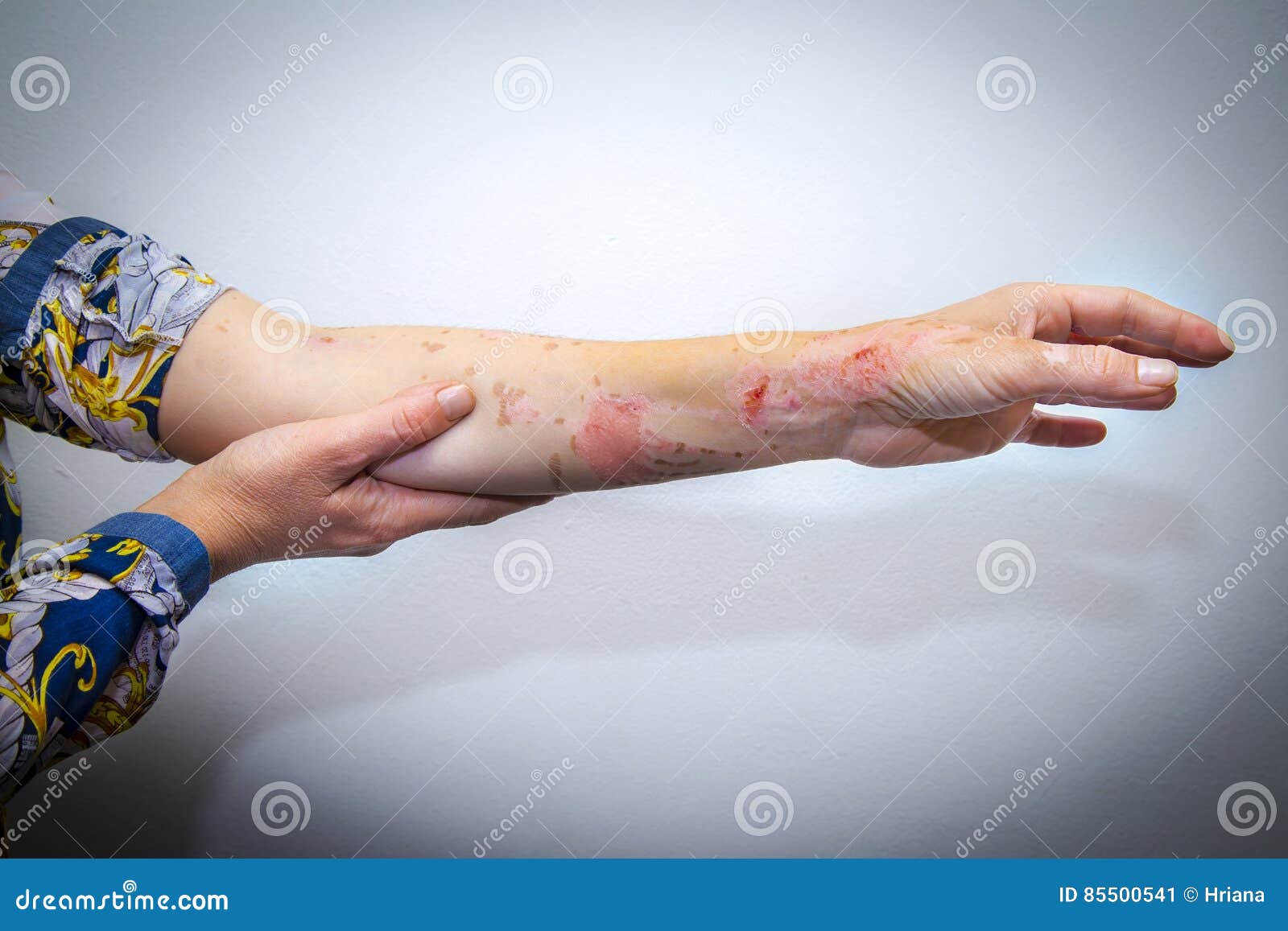 Skin burns on human arm stock image. Image of health - 85500541