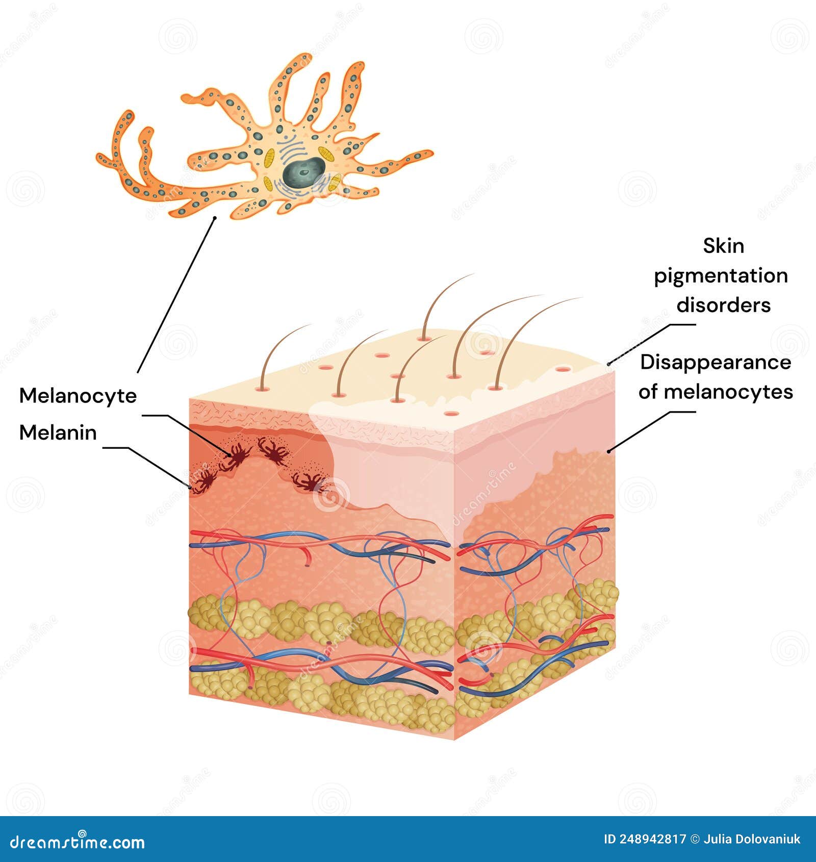 Vitiligo Cartoon Vector | CartoonDealer.com #33694423