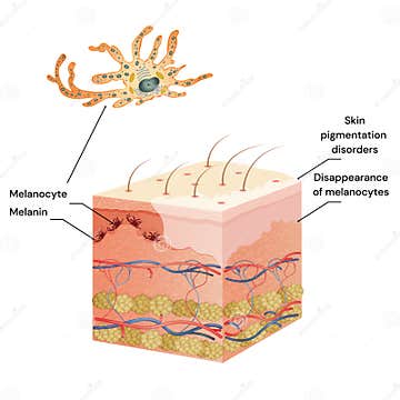 Skin Cut Medicine Problem Skin Vitiligo. Stock Vector - Illustration of ...