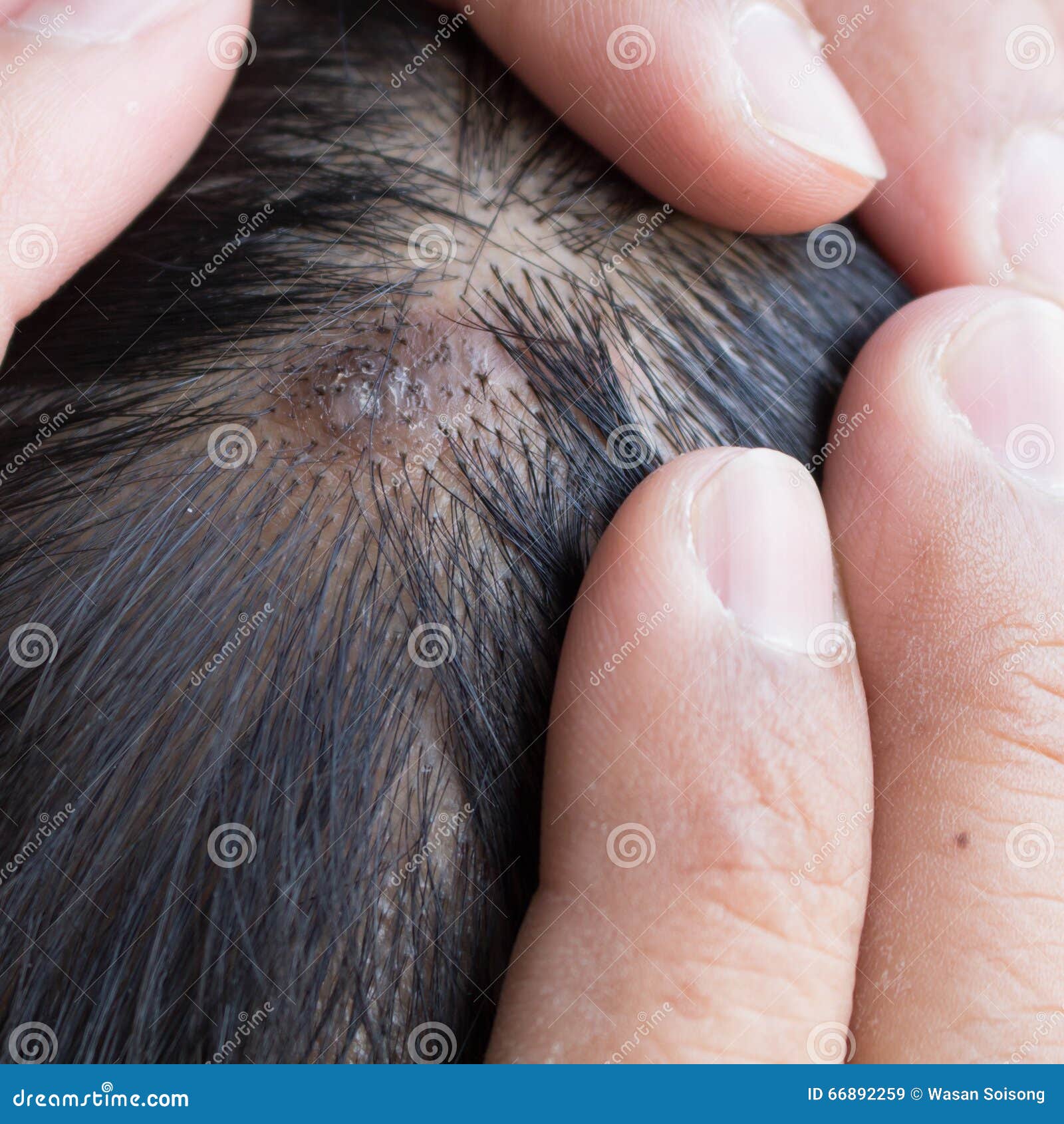 Skin disease on the head stock image. Image of shallots - 66892259
