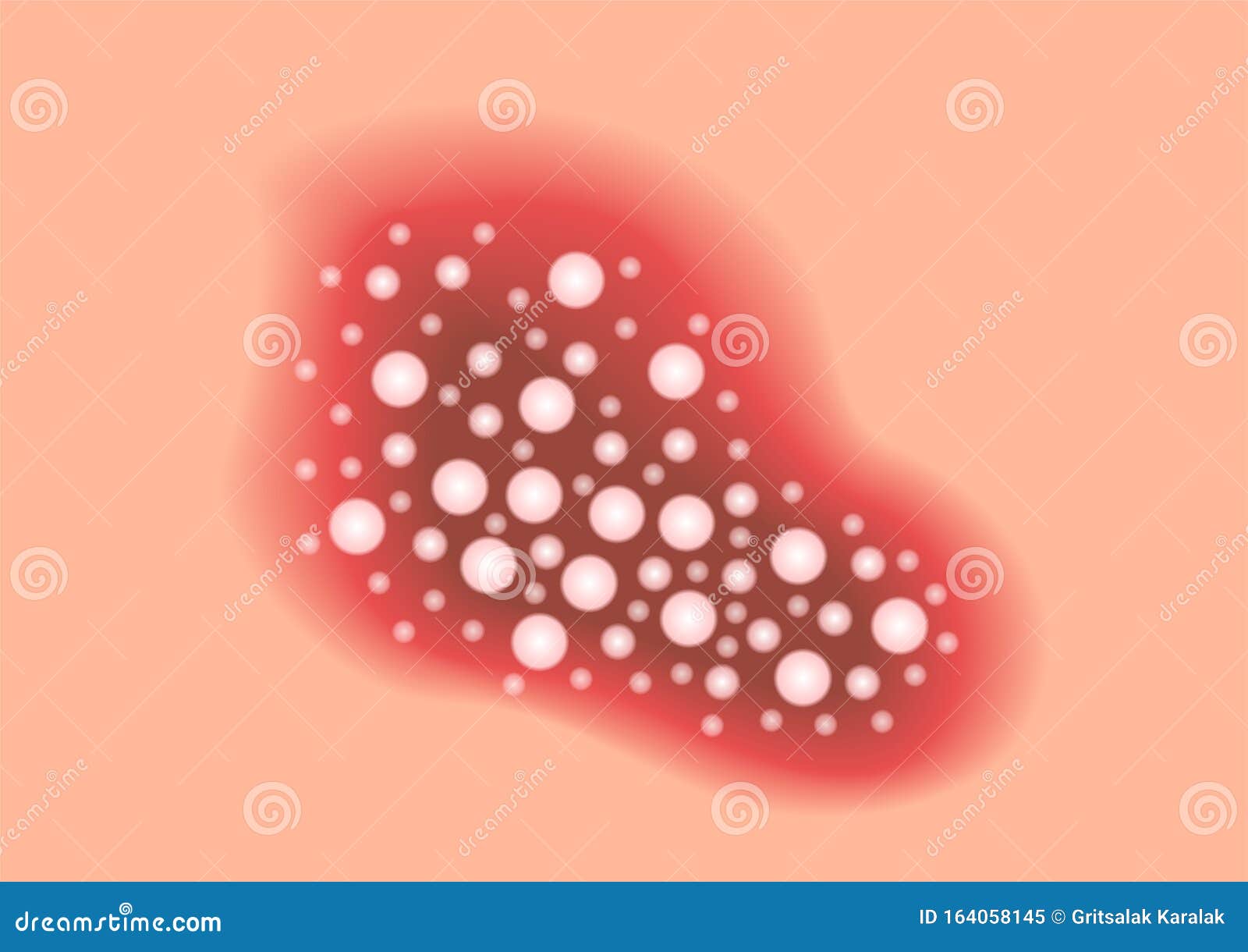 Skin Disease. Different Diseases, Epidermis Surface With Eczema ...