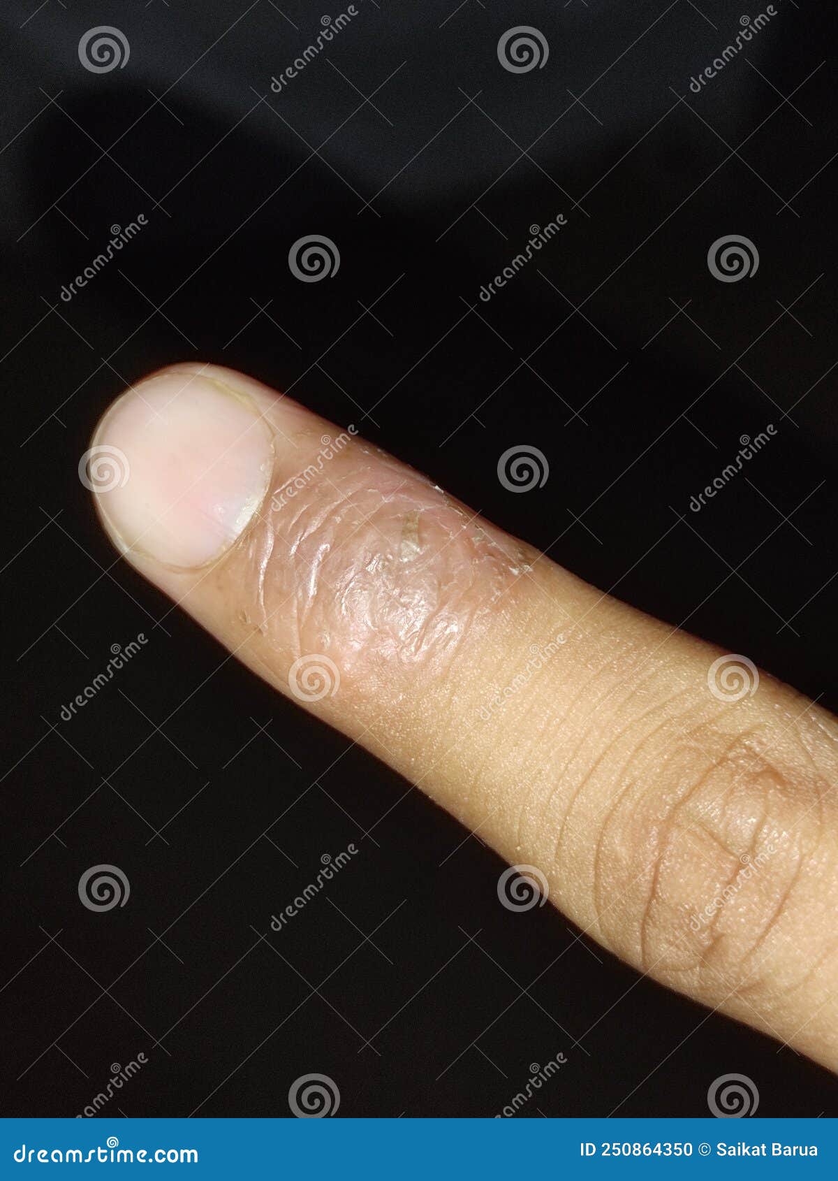 Skin Diseases and the Problem Around the Hand and Finger Stock Photo ...