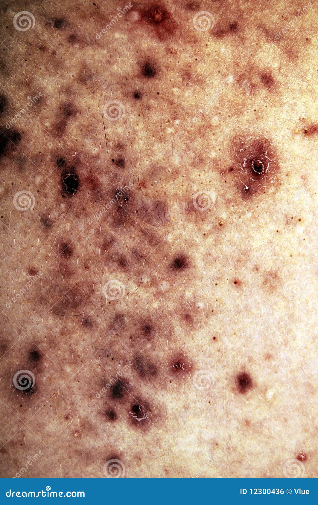 Skin disorder stock photo. Image of cancer, sick, contamination - 12300436