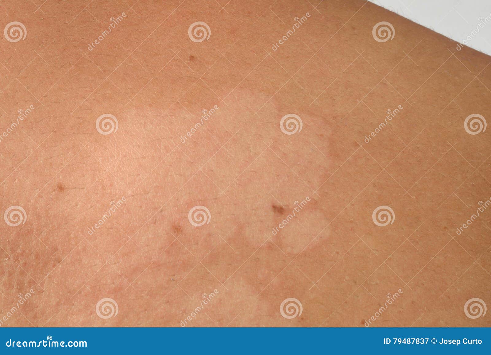 Skin fungus back stock image. Image of closeup, body - 79487837