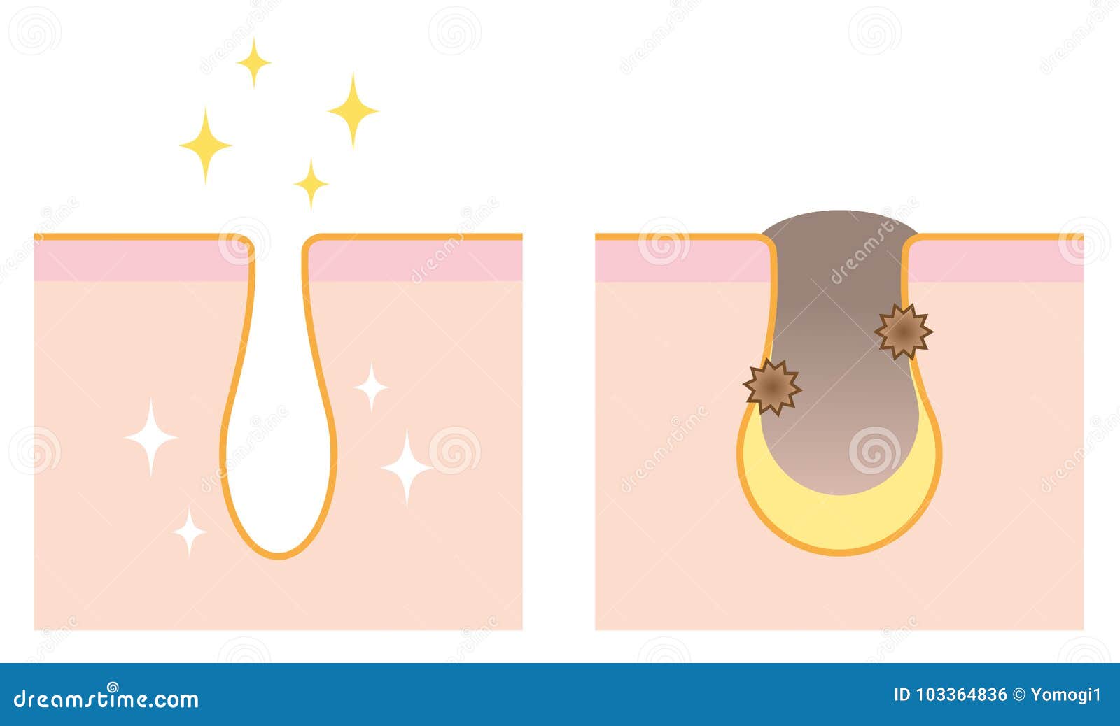 Clogged Pores On Face Diagram