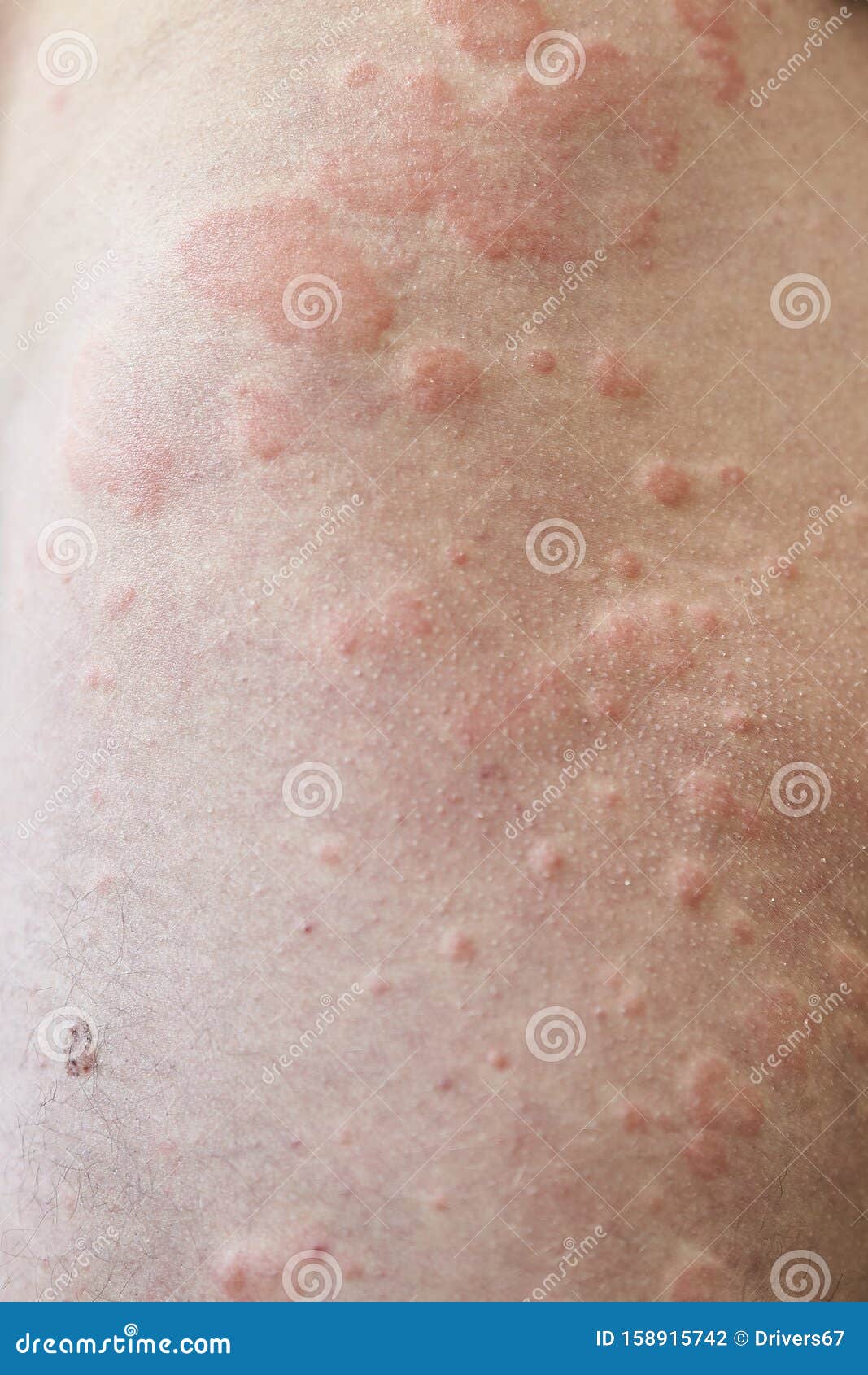 Skin Imperfection Skin Allergy Urticaria Disease Red Spots On The