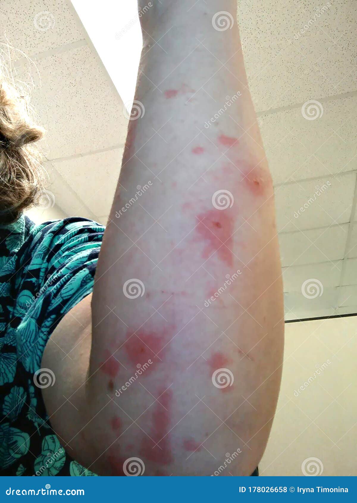 Skin Inflammation. Dermatitis on the Skin of the Hand Stock Photo ...