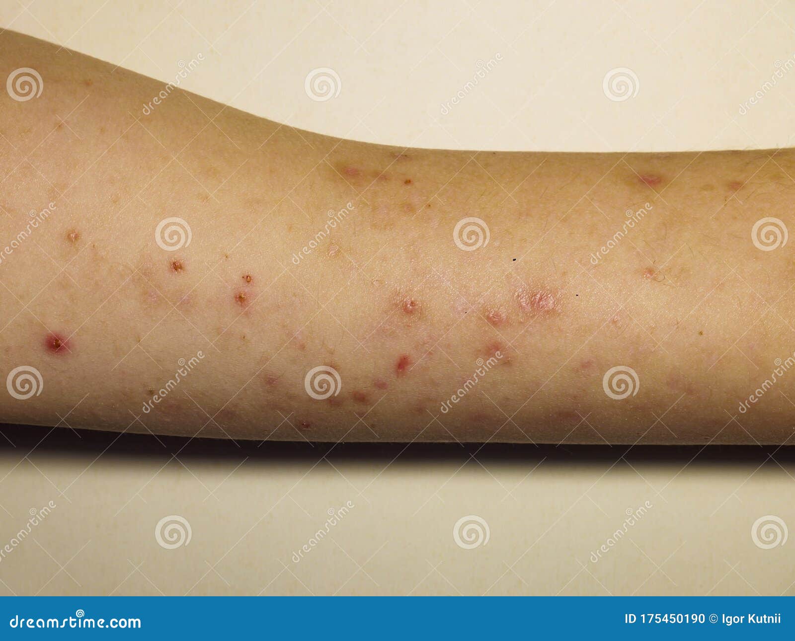 Skin Allergic Irritations in the Form of a Rash Stock Photo - Image of ...