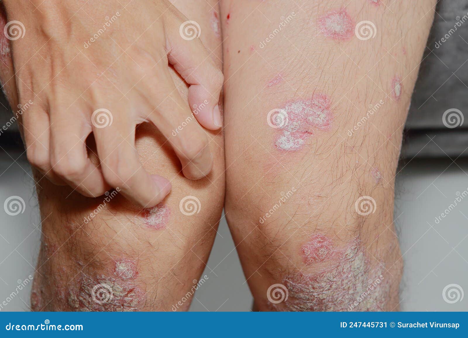 Skin Itching, Skin Disease, Skin Rashes, Allergy Stock Photography ...