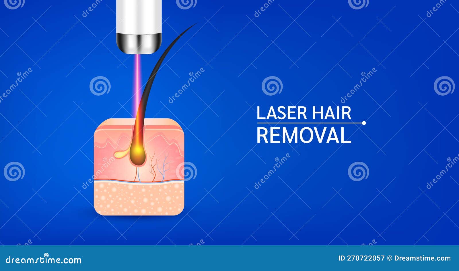 Skin Layers Anatomy With Hairs And Yellow Laser Light Hair Removal