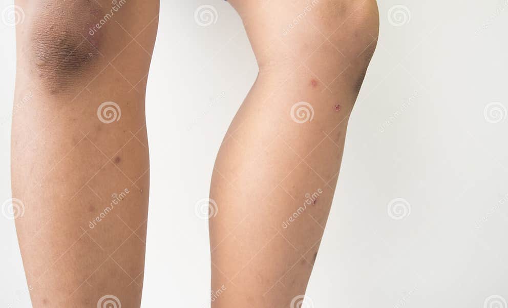 Skin of the leg is scars stock image. Image of body - 303125027