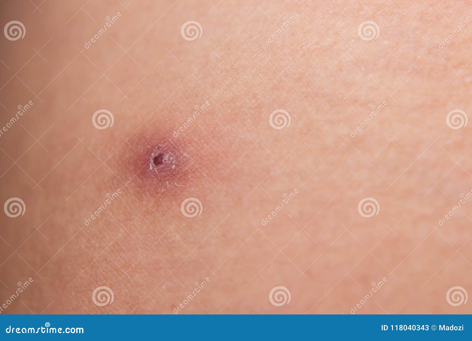 Lesion On Arm Skin Begin Scab Dried On The Epidermis. Stock Photo ...