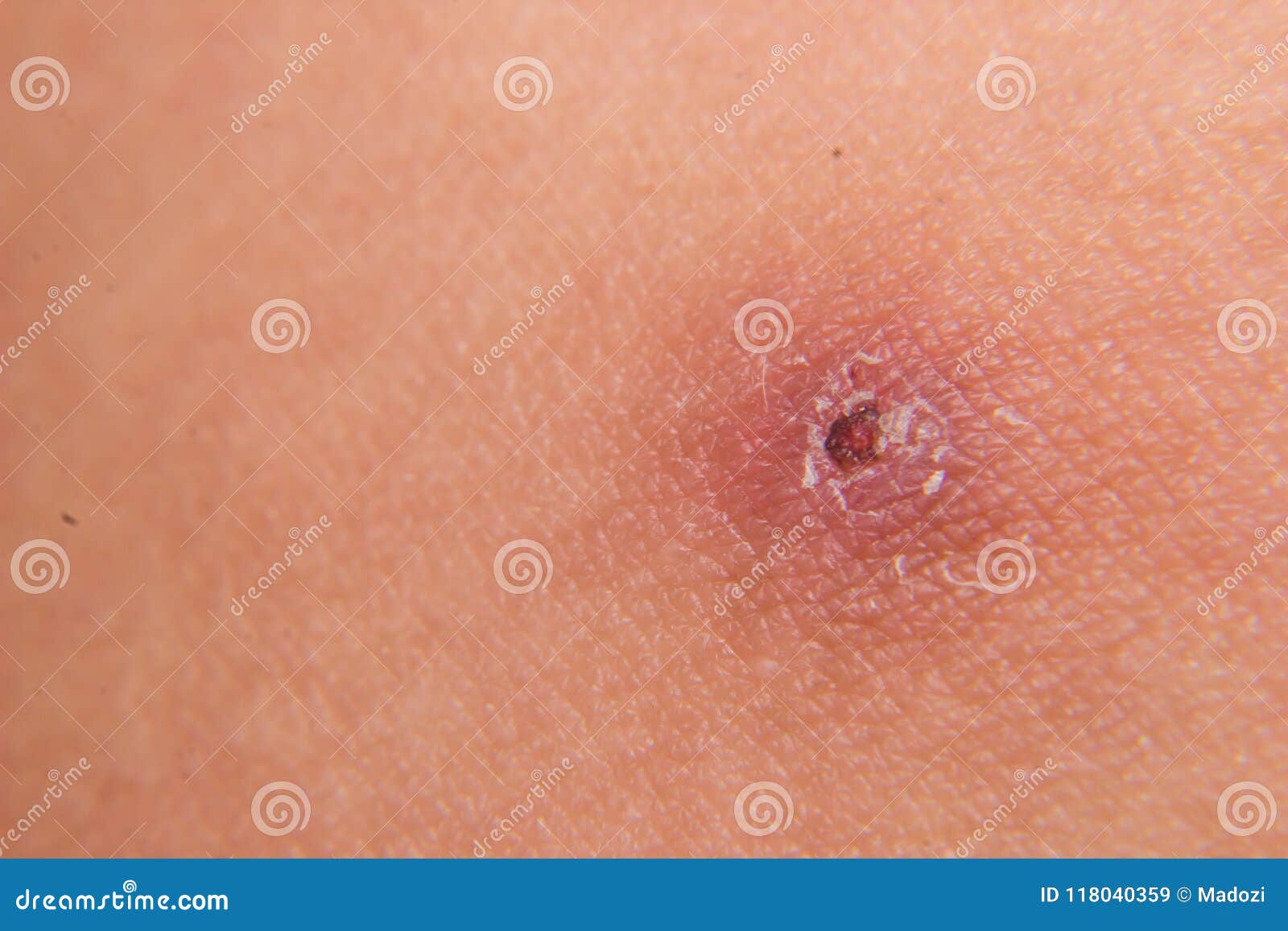 Lesion On Arm Skin Begin Scab Dried On The Epidermis. Stock Photo ...