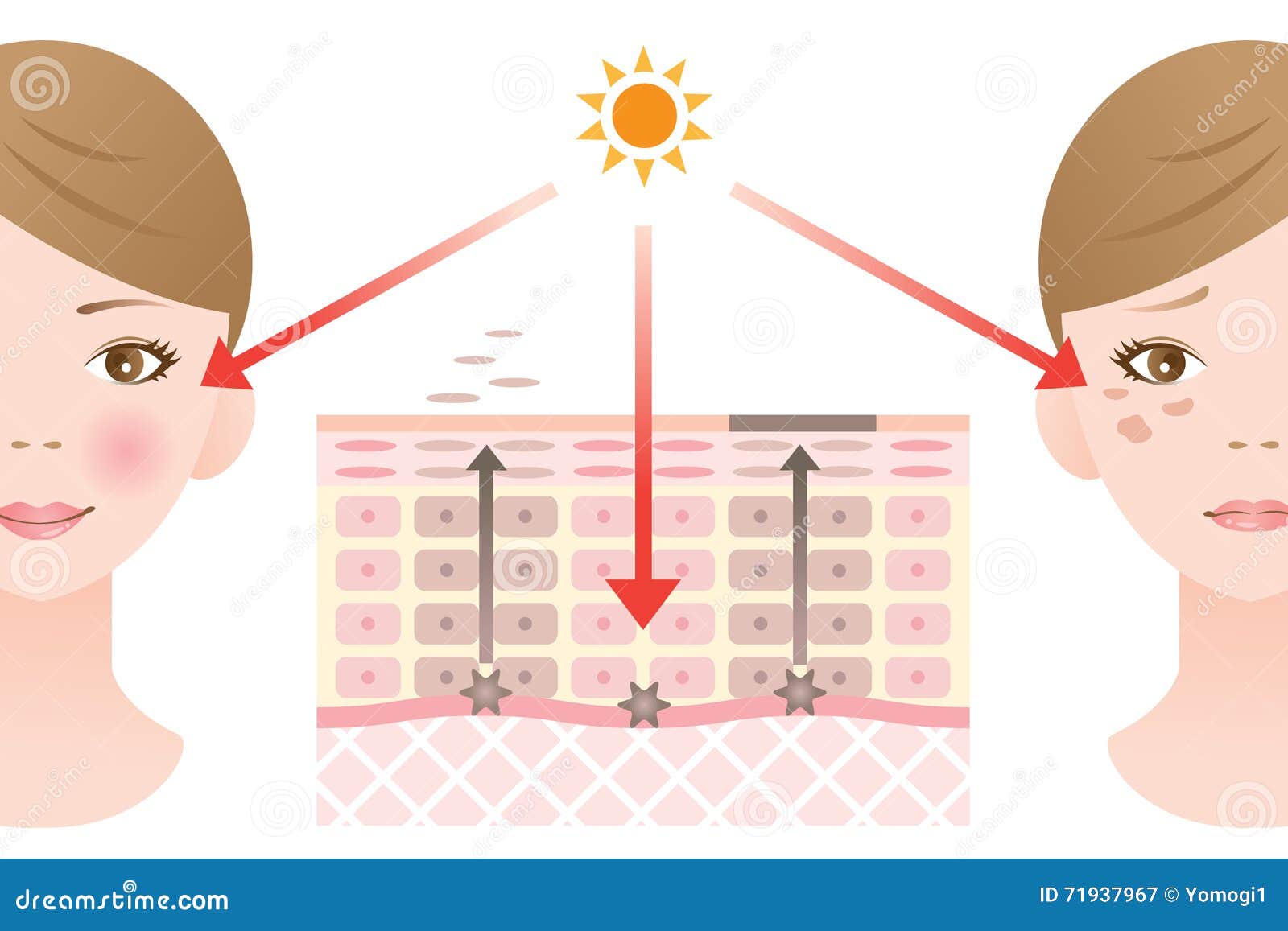 Skin Mechanism Of Blotches Cartoon Vector | CartoonDealer.com #71939071 Skin Mechanism Of Blotches Cartoon Vector | CartoonDealer.com #71939071