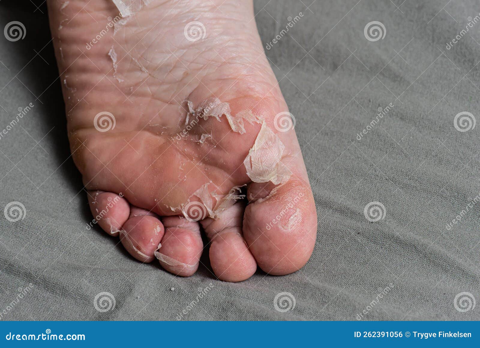 Skin peeling off a foot.. stock photo. Image of beautiful - 262391056