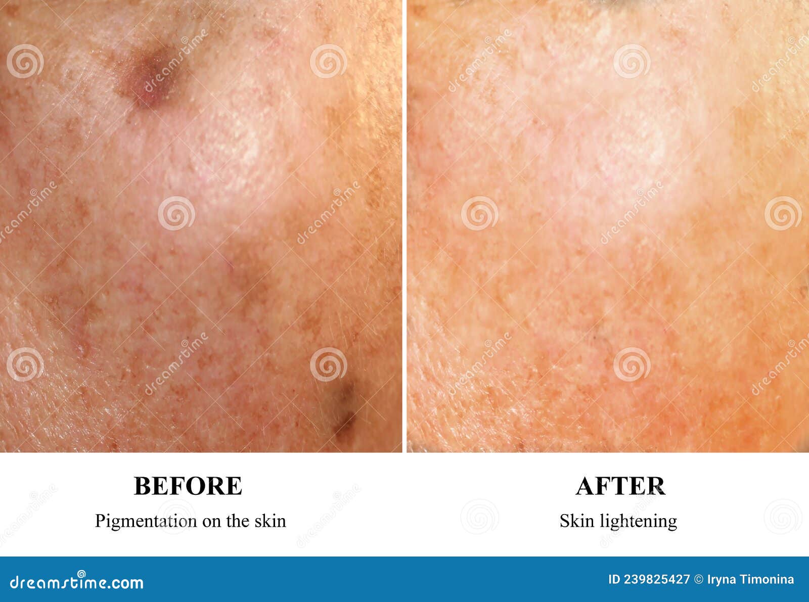 Skin Pigmentation Brown Patches
