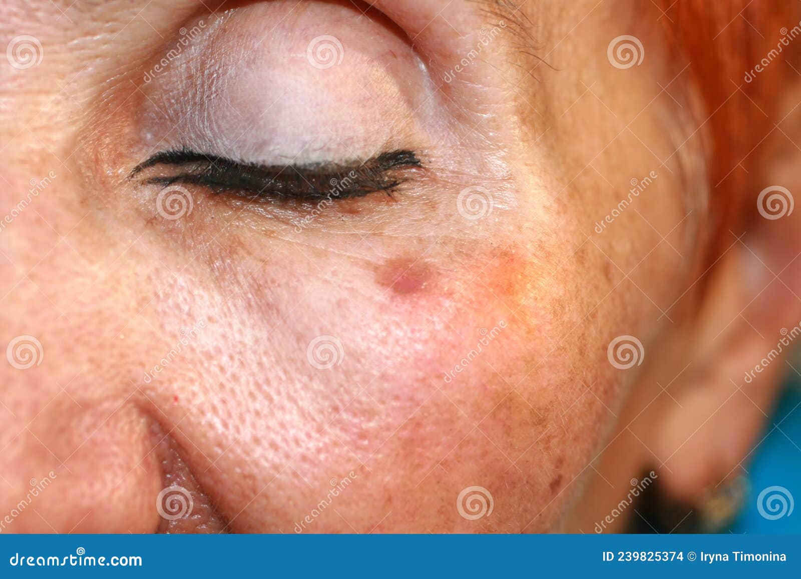 Skin Pigmentation. Brown Spots of Pigmentation on the Skin of the Face ...