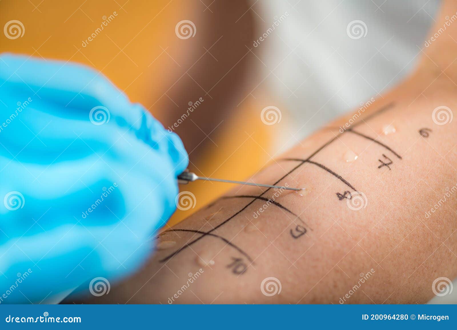 Skin Allergy Testing stock photo. Image of immunology - 200964280