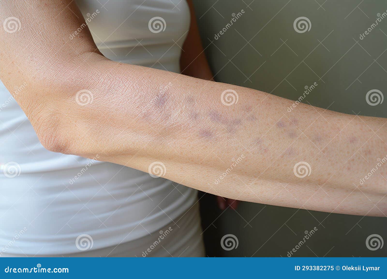 Skin Problem, Atopic Eczema Stock Image - Image of dermatologists ...