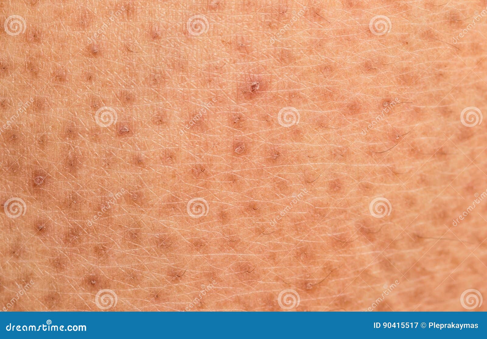Skin Problem,Dry Skin Ichthyosis Vulgaris Stock Image - Image of ...