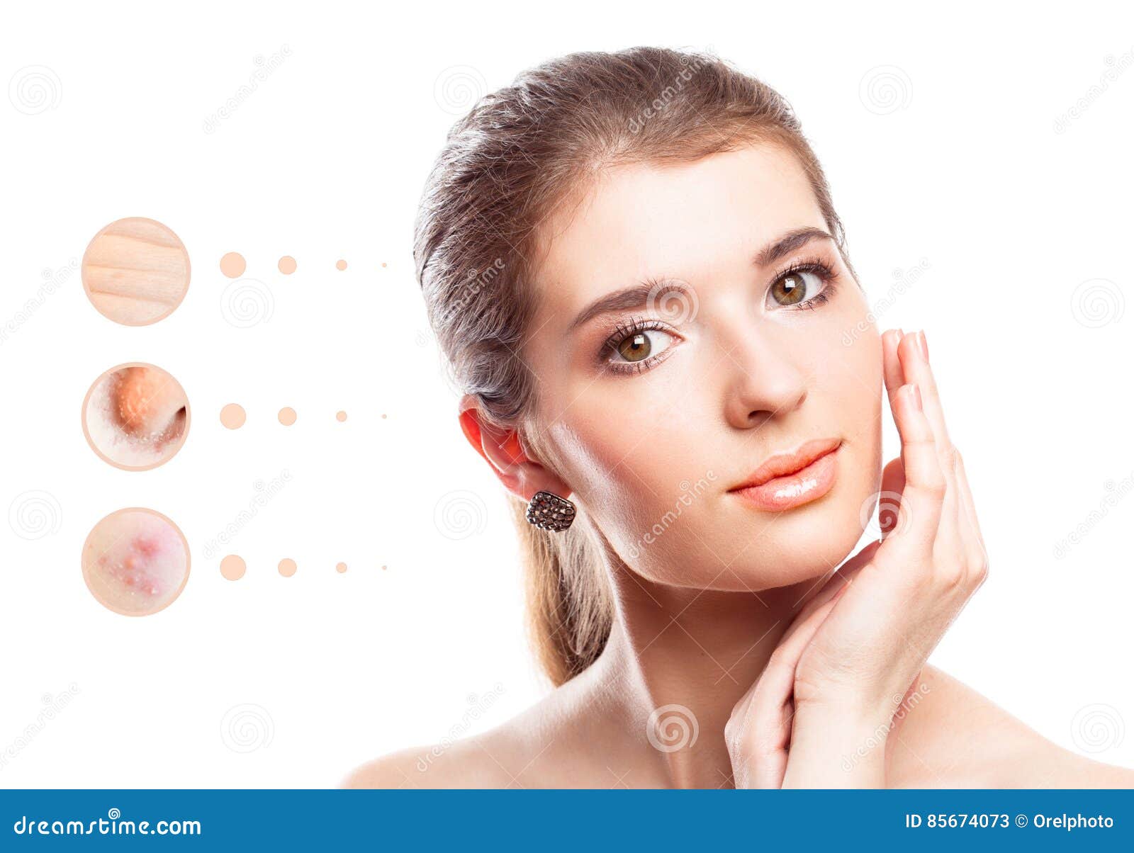 Skin problem of woman face stock image. Image of acne - 85674073