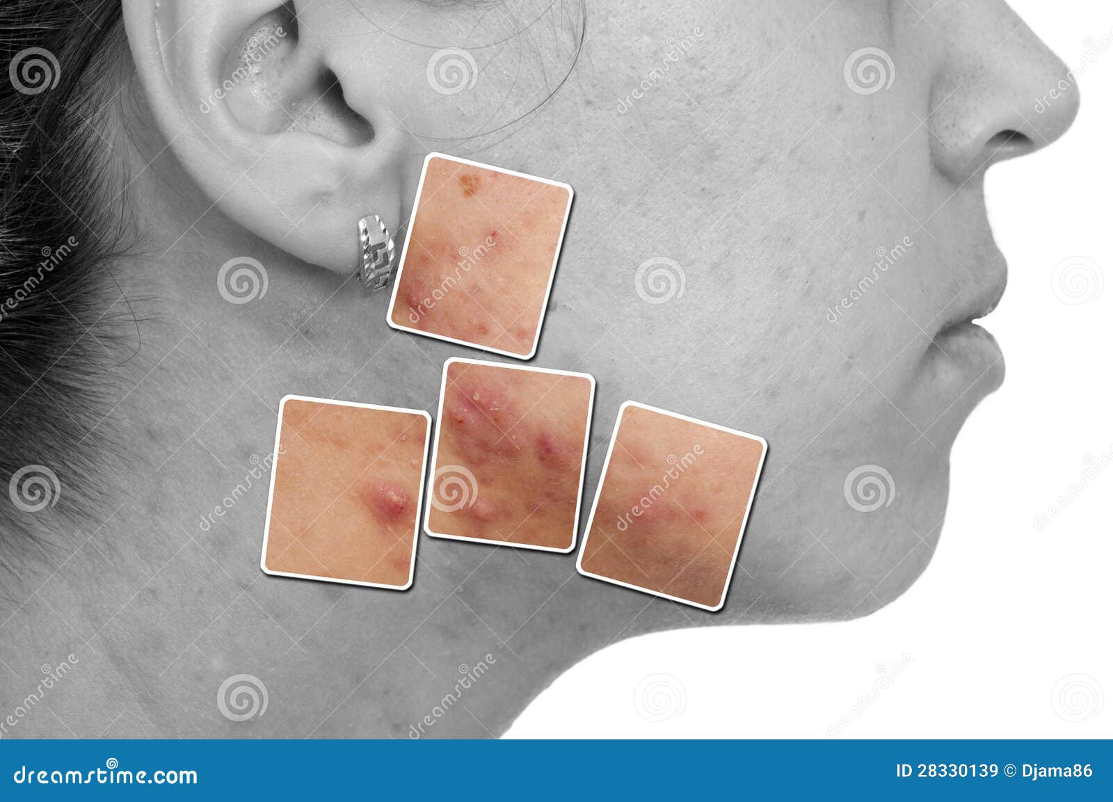 Skin problems stock image. Image of antiviral, face, beauty - 28330139