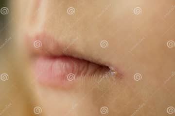 Skin Problems, Angulitis, Angular Stomatitis, Angular Cheilitis a ...