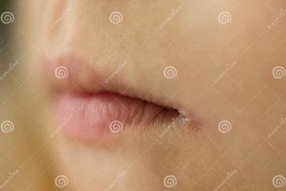 Skin Problems, Angulitis, Angular Stomatitis, Angular Cheilitis a ...