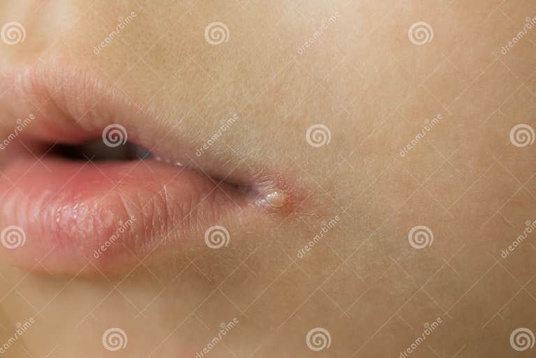 Skin Problems, Angulitis, Angular Stomatitis, Angular Cheilitis a ...