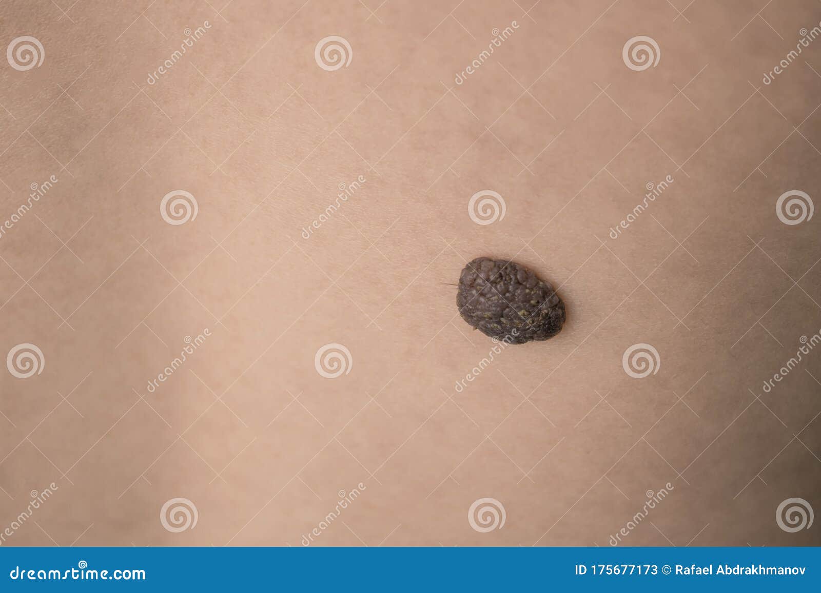 Skin Problems Closeup. Big Scary Mole on the Female Back Stock Image ...