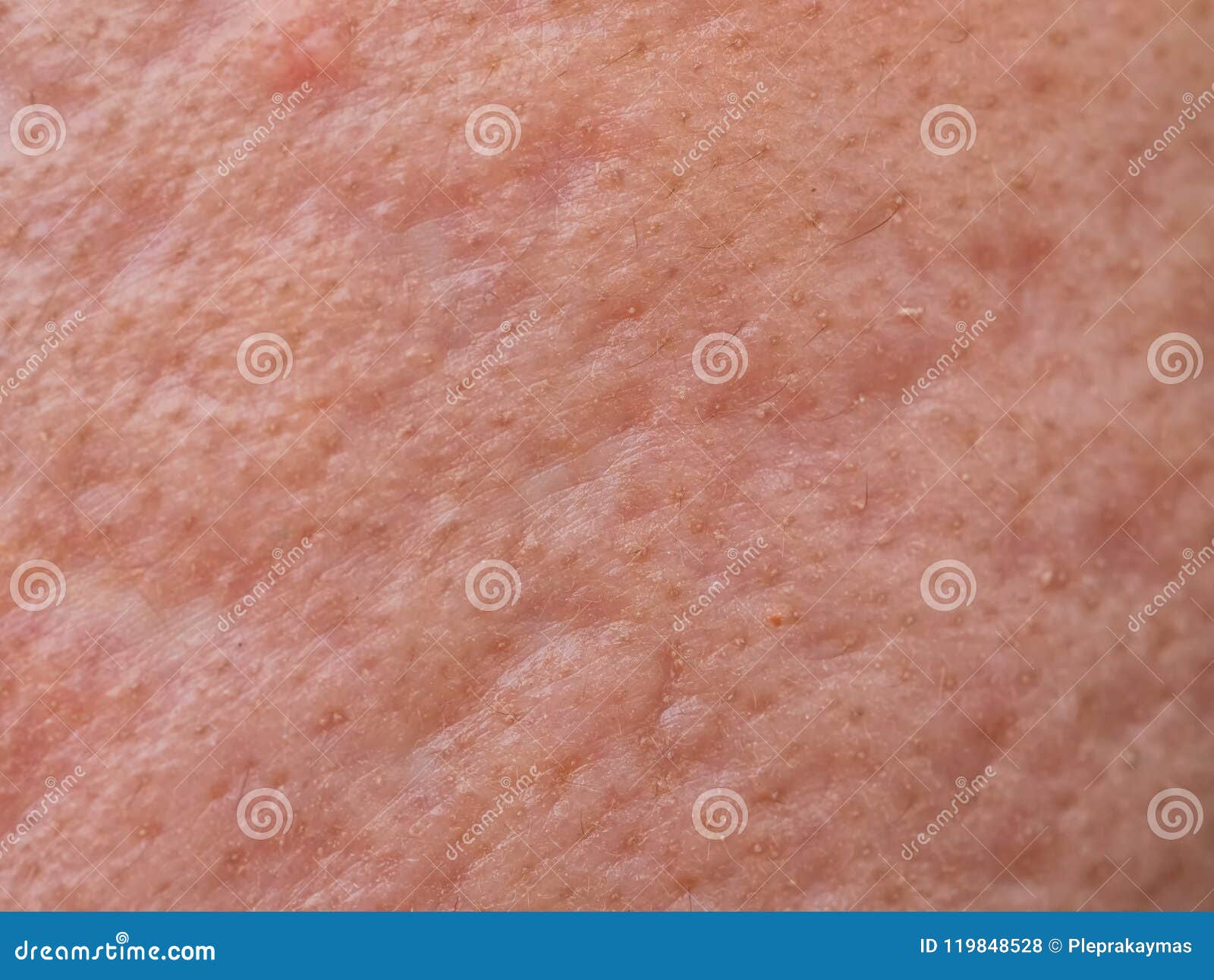 Skin Problems, Nodular Cystic Acne Skin Stock Photo - Image of ...