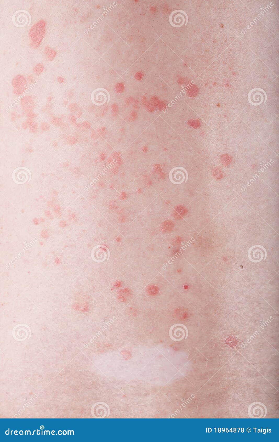 Skin with psoriasis stock photo. Image of eczema, care - 18964878