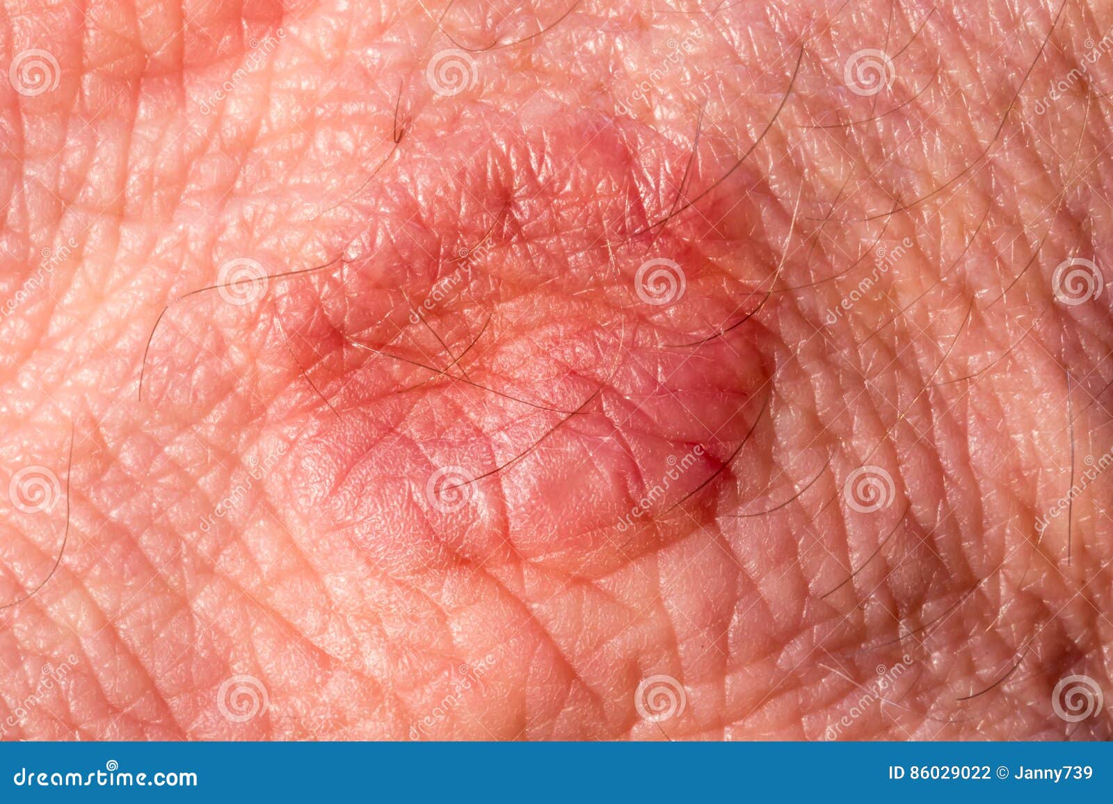 Skin With Rash / Eczema Stock Photography | CartoonDealer.com #86029022