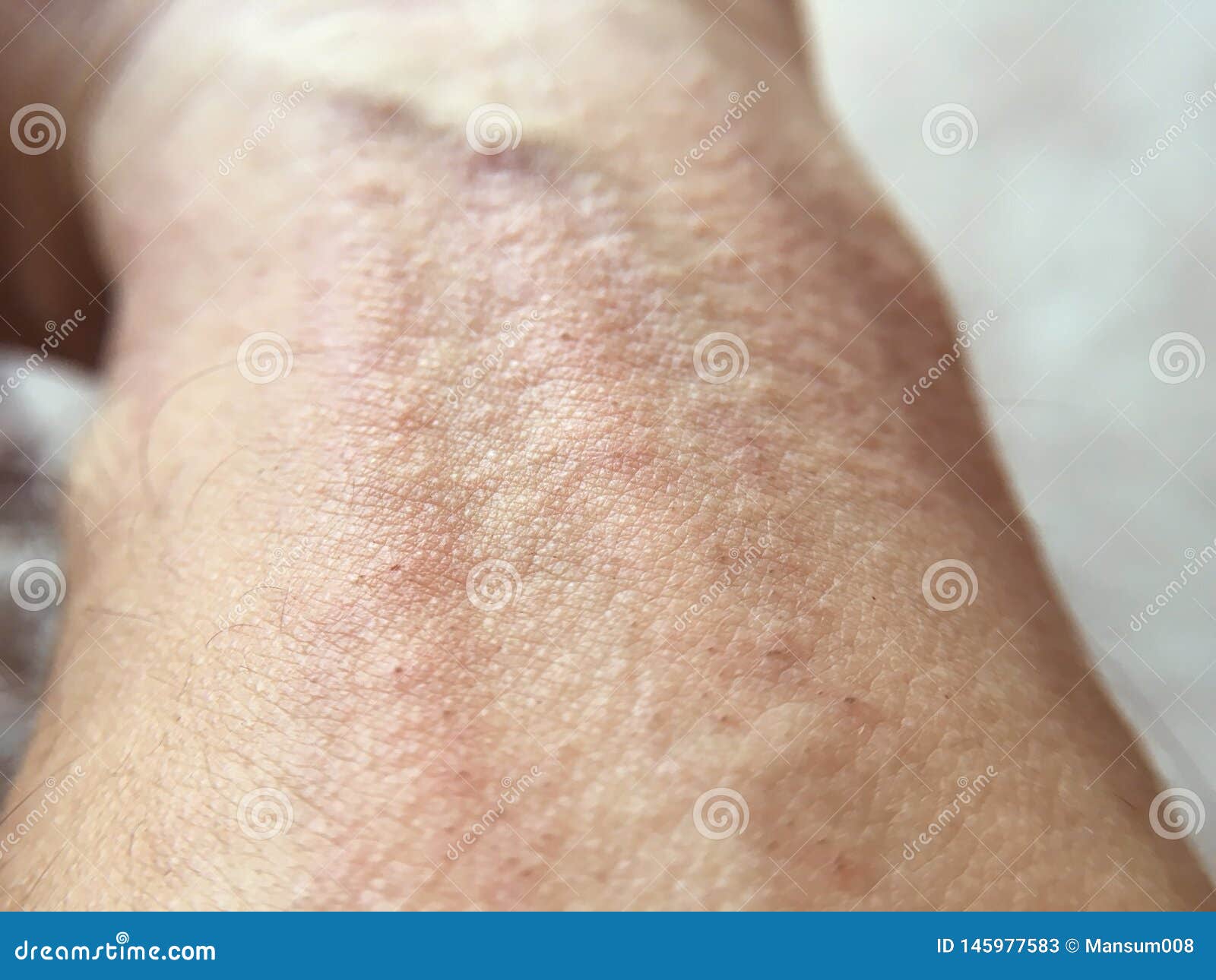 Skin rash on man hand stock image. Image of macro, infection - 145977583
