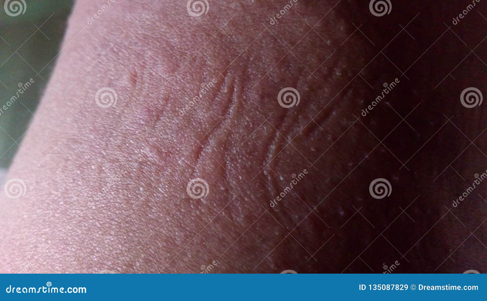 Skin Rashes, Allergies Contact Dermatitis Royalty-Free Stock Image ...