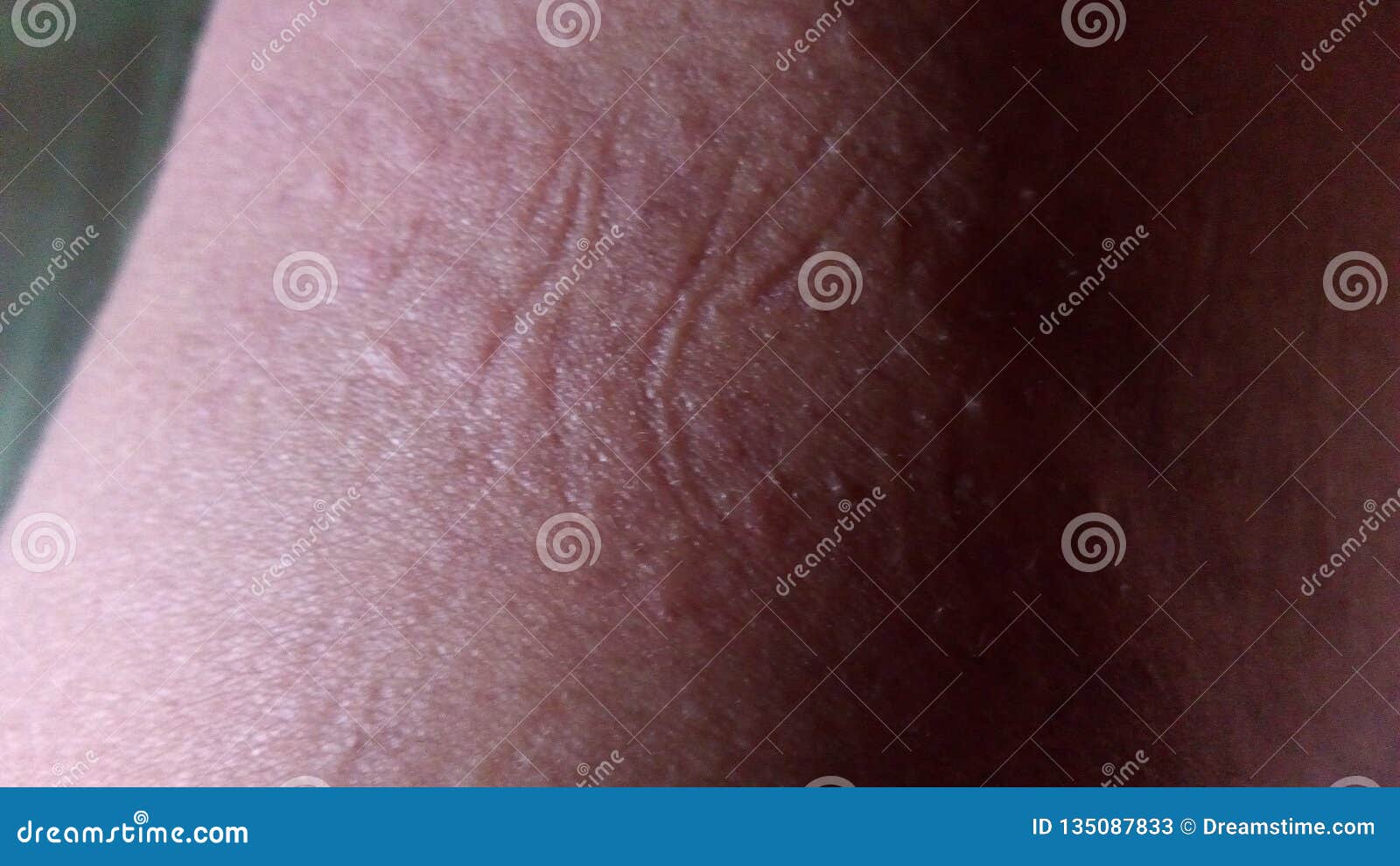 Skin Rashes, Allergies Contact Dermatitis ,allergic To Chemicals ...