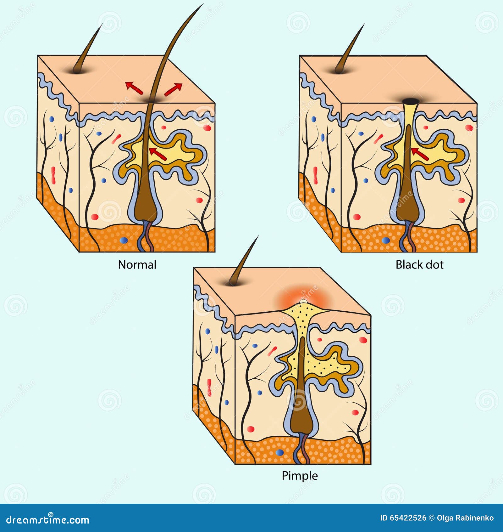 Skin Rashes Dark Dot Whelk Vector Illustration | CartoonDealer.com ...