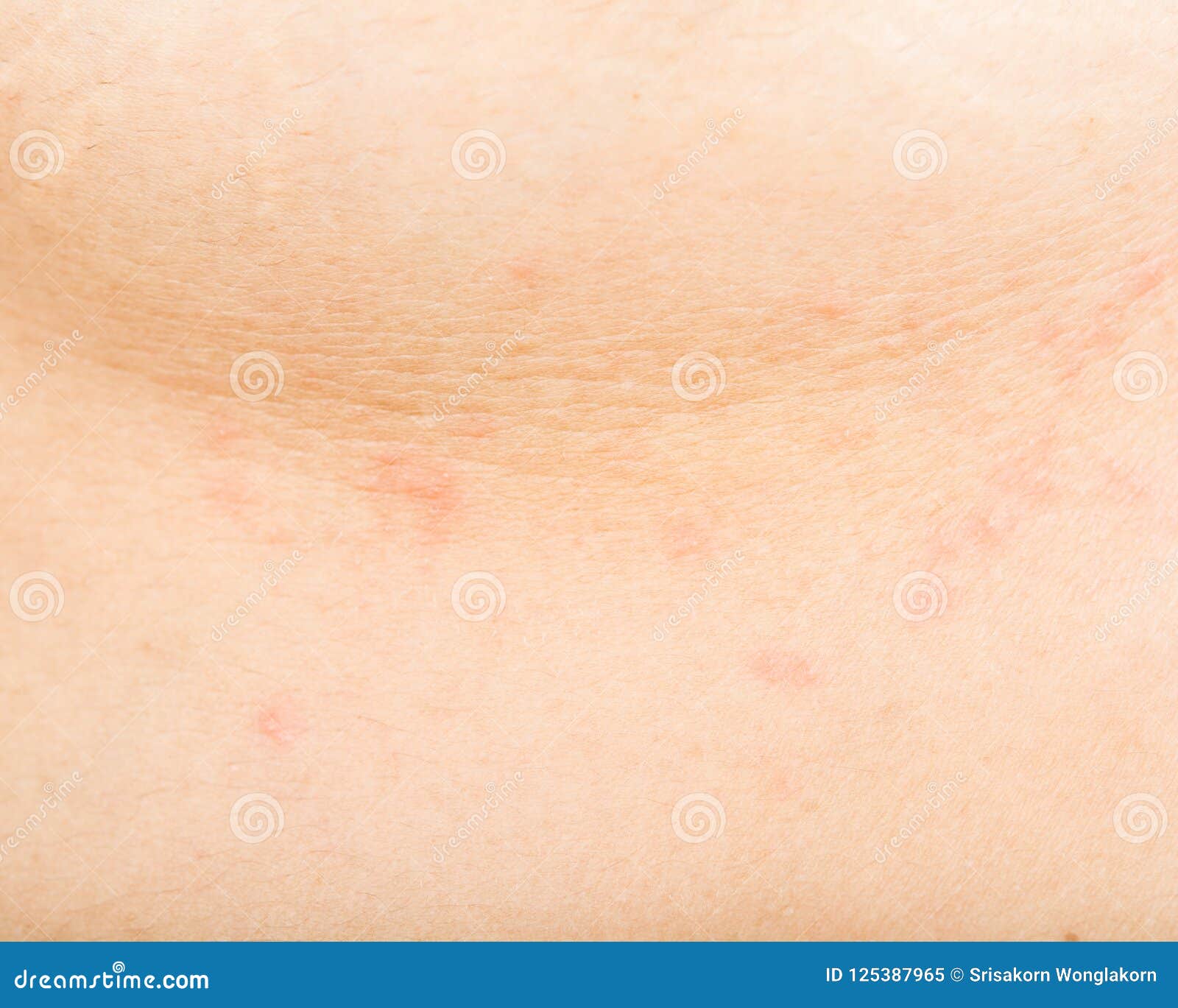 Skin Rashes and Inflammation. Stock Image - Image of healthy, rashes ...