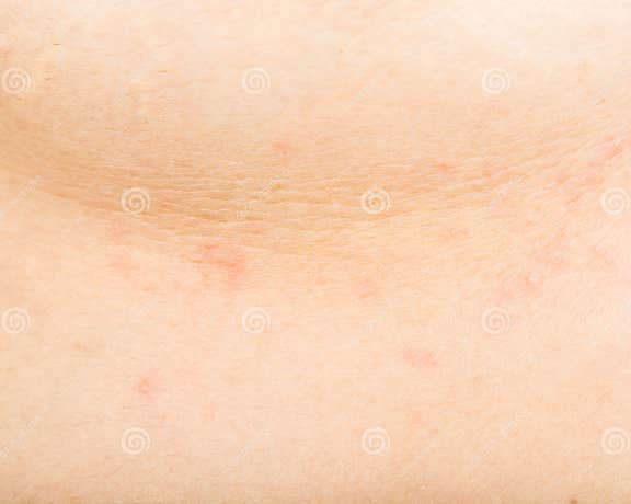 Skin Rashes and Inflammation. Stock Image - Image of healthy, rashes ...