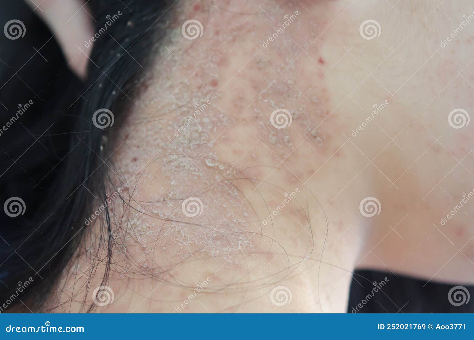 Skin Rashes On The Neck Of Women Caused By Allergies To Chemicals Food