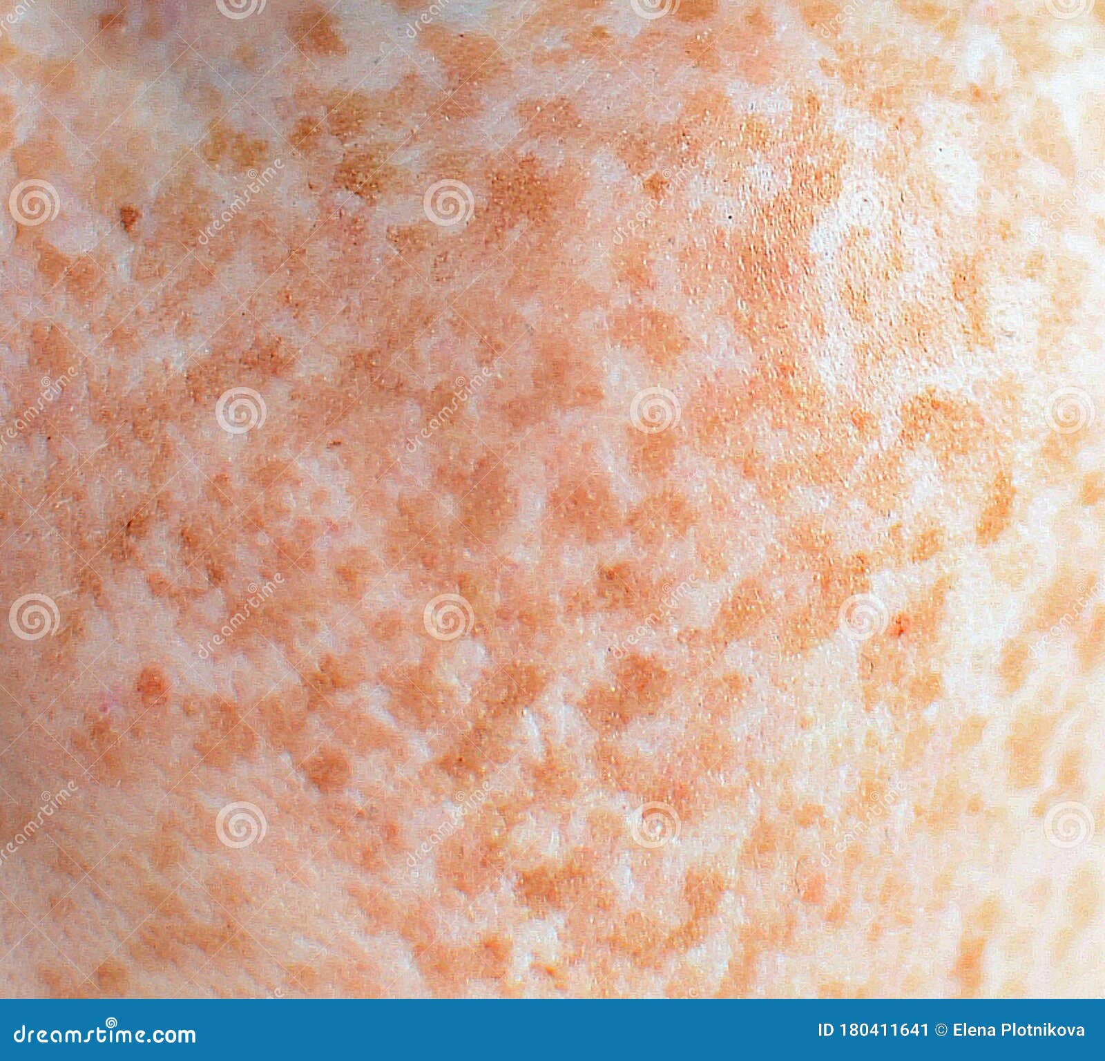 Skin with Red Freckles, Close-up, Macro Stock Image - Image of fragment ...