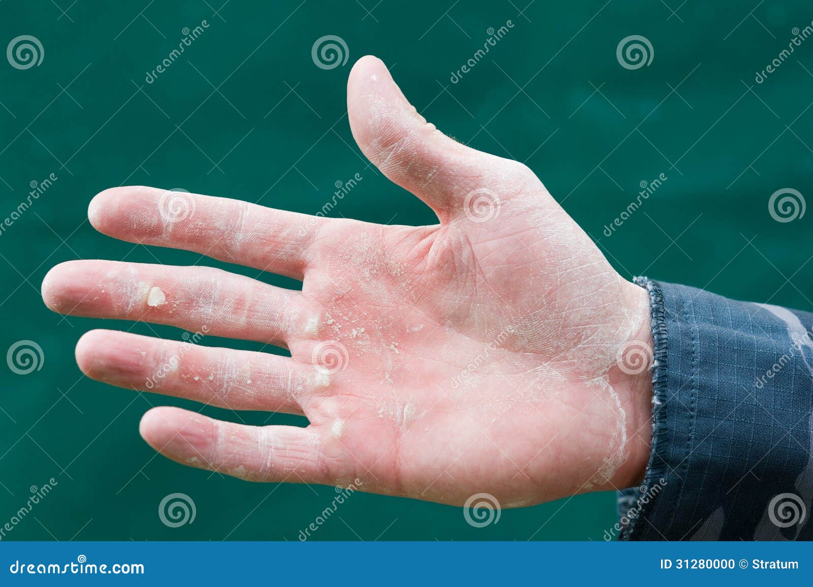 Skin rips on a hand. stock photo. Image of worker, manly - 31280000
