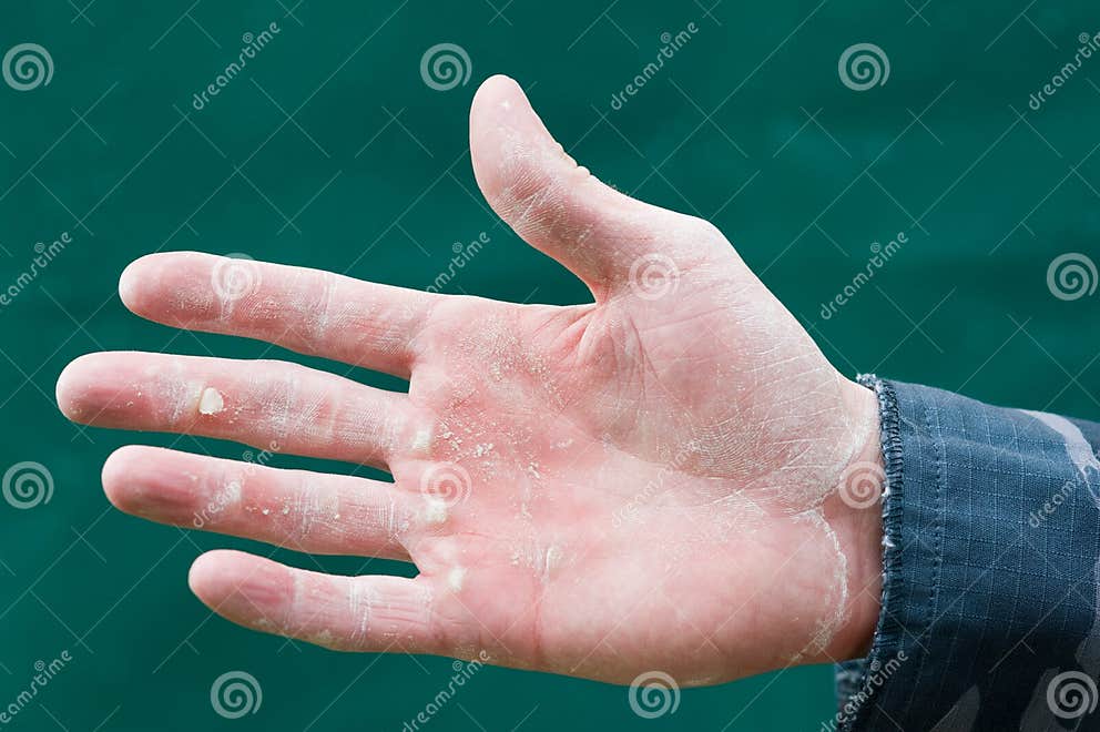 Skin rips on a hand. stock photo. Image of worker, manly - 31280000