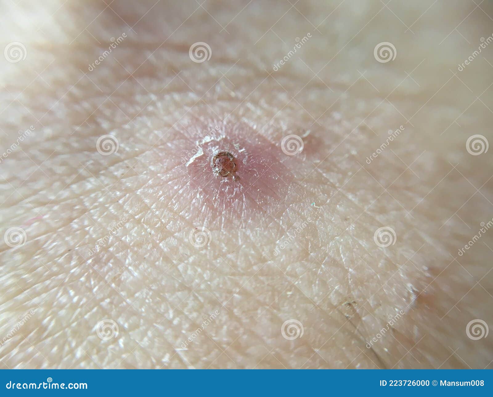 Skin and scar on foot stock photo. Image of health, rugged - 223726000