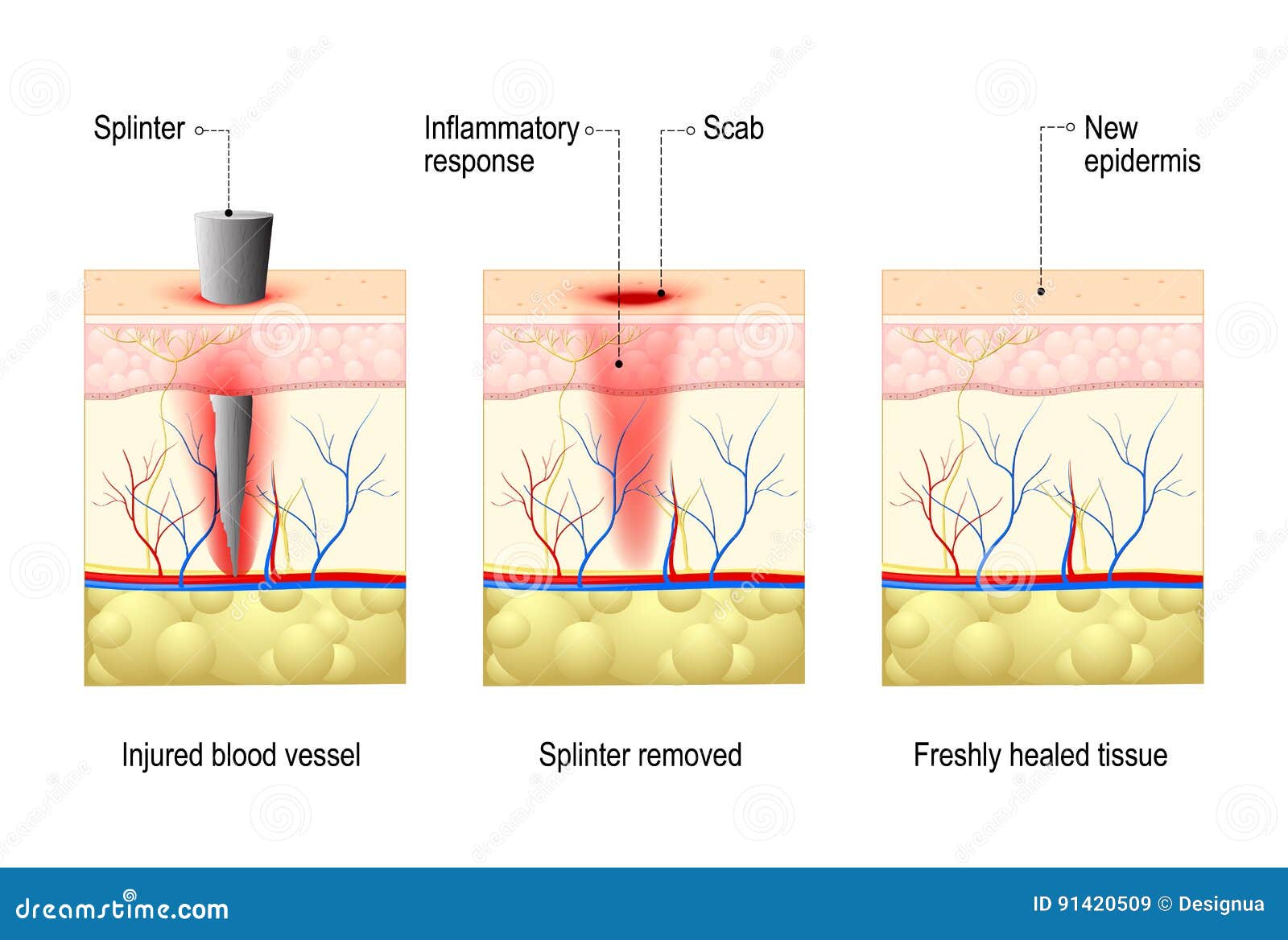 Skin with Splinter and Wound Healing. Stock Vector - Illustration of ...